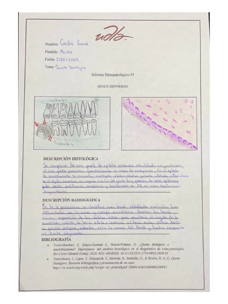 Informe Quiste Dentigero Ceci | PDF
