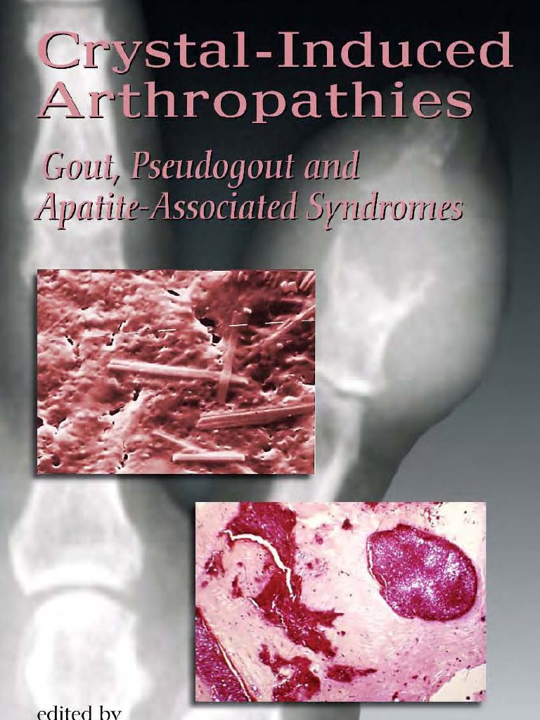 gout book | Gout | Incidence (Epidemiology)