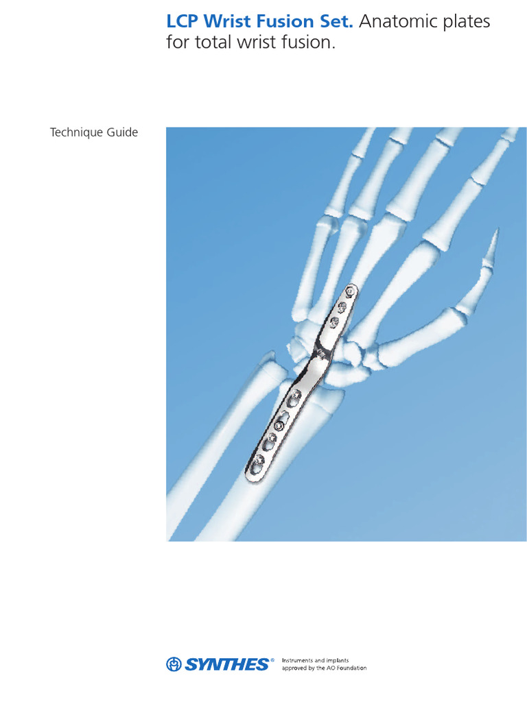 LCP Wrist Fusion Technique Guide | PDF | Screw | Hand