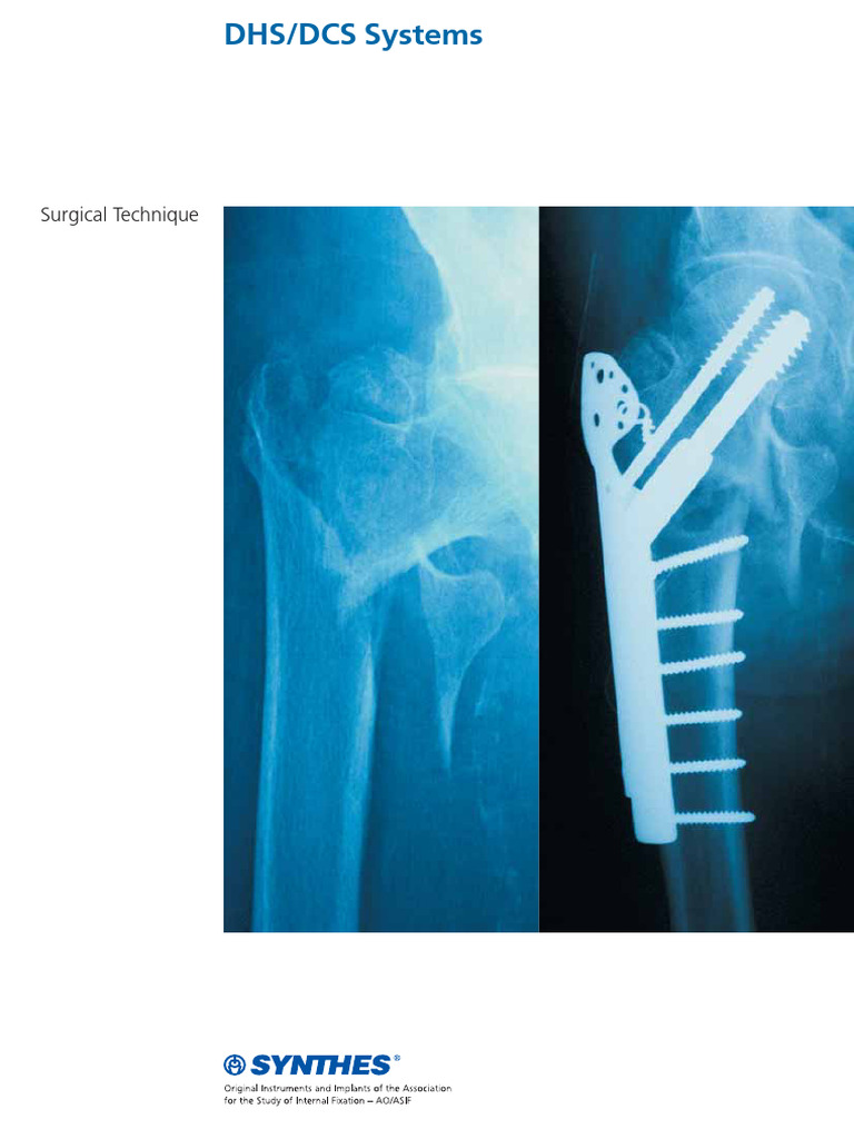 036.000.523 DHS - DCS | PDF | Hip | Musculoskeletal System