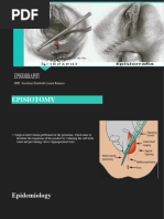 Episiotomy and Perineal Tear Repair Guide | PDF | Childbirth | Vagina