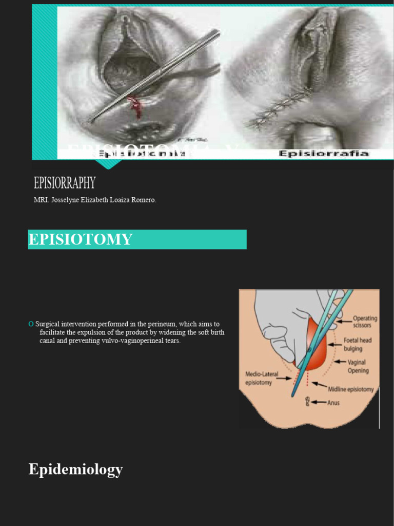 Episiotomy and Episiorrhaphy | PDF | Childbirth | Clinical Medicine