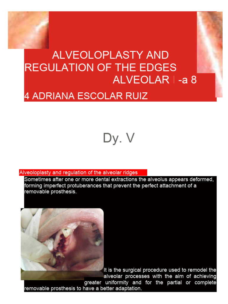 Alveoloplasty and Regulation of Alveolar Ridges | PDF | Mouth | Medical ...