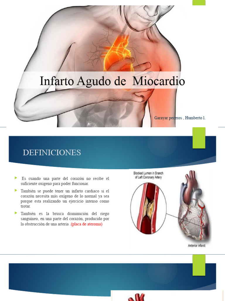 Infarto 191001181610 | PDF | Infarto de miocardio | Estatinas