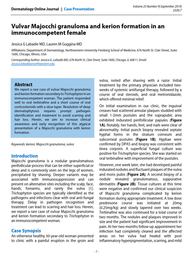 Vulvar Majocchi Granuloma and Kerion Formation in An Immunocompetent ...