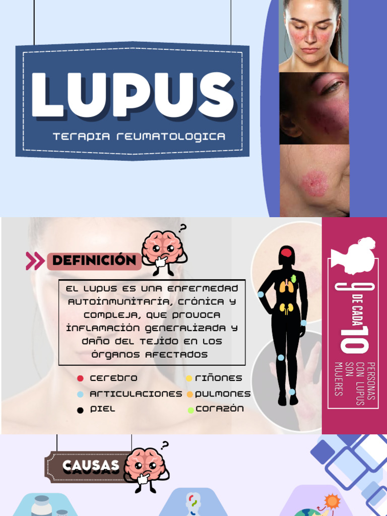 Guía Completa sobre el Lupus | PDF | Inmunología | Enfermedades y ...