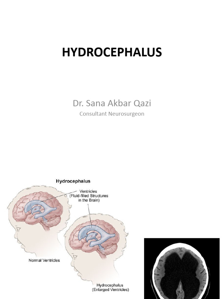 Hydrocephalus | PDF | Cerebrospinal Fluid | Diseases And Disorders