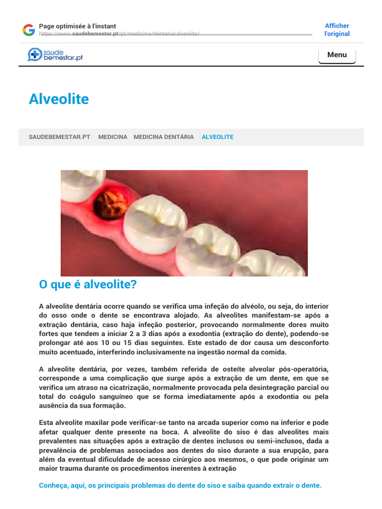 Alveolite - Seca Ou Purulenta - Sintomas, Tratamen | PDF | Dente humano ...