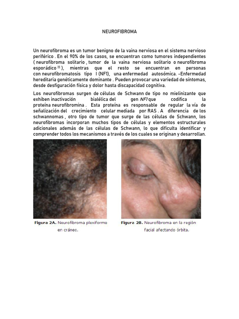 Neurofibromas: Tipos y Complicaciones | PDF | Biología | Enfermedades y ...