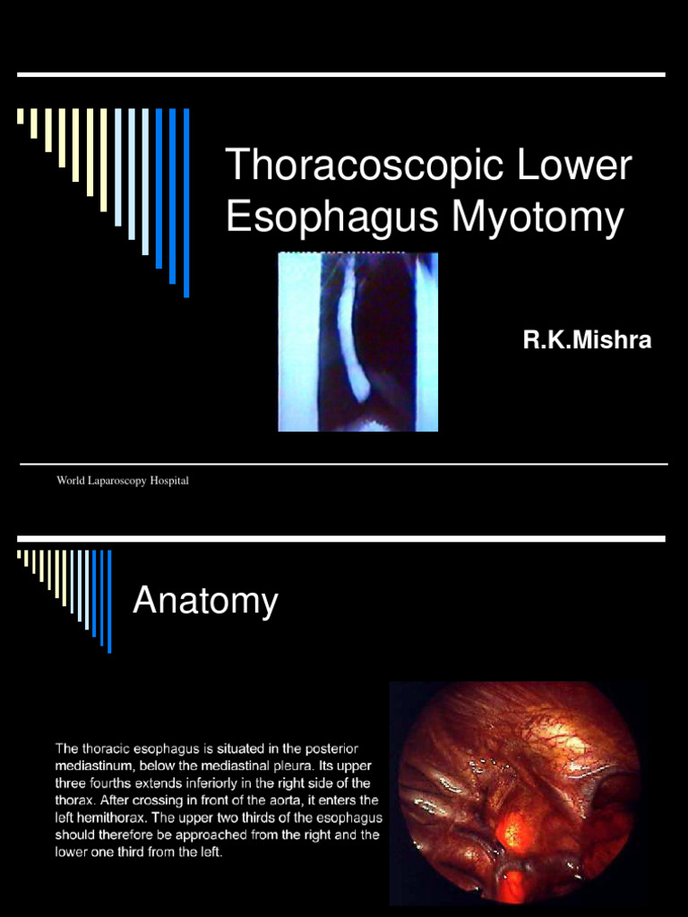 Thoracoscopic Esophagus Myotomy Guide | PDF