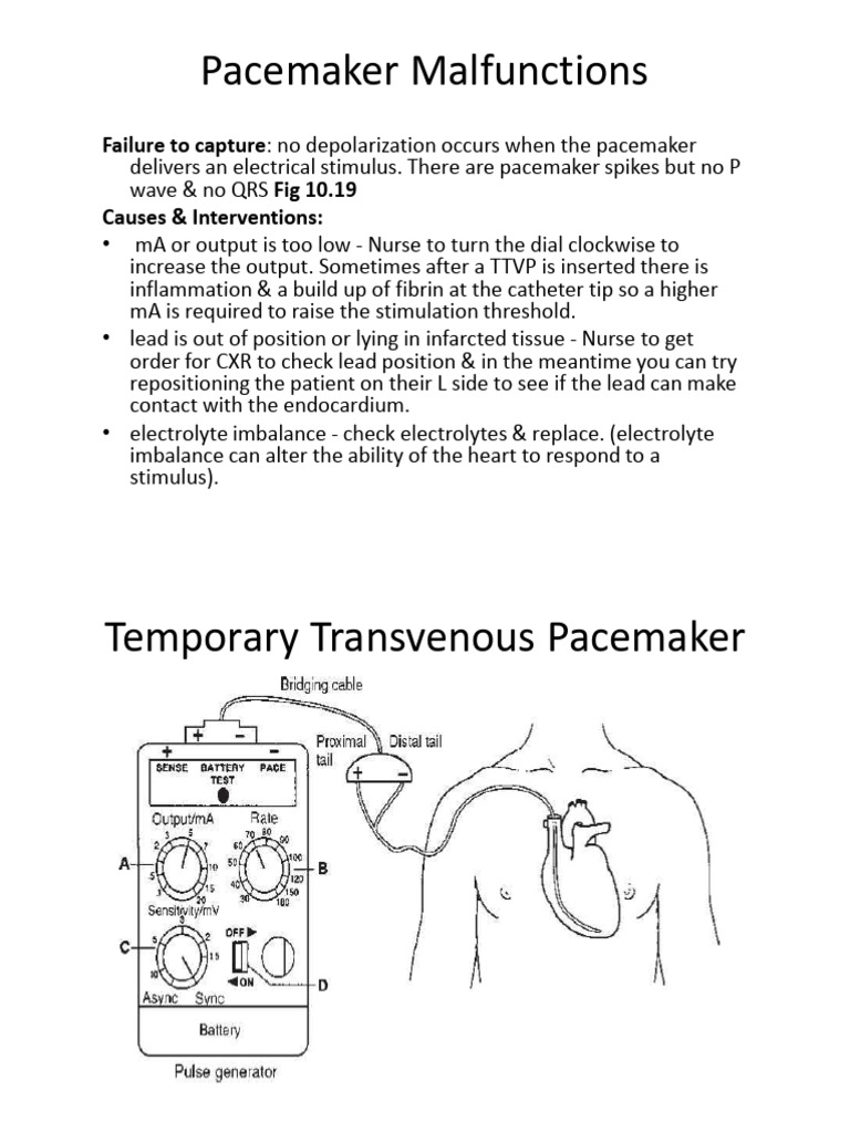 Pacemaker Malfunction | Download Free PDF | Artificial Cardiac ...