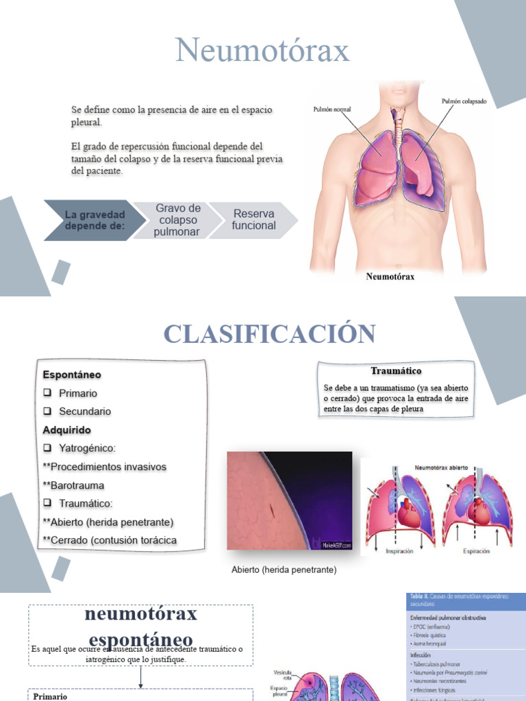 Neumotorax Presentacion | PDF | Medicina CLINICA | Enfermedades y trastornos