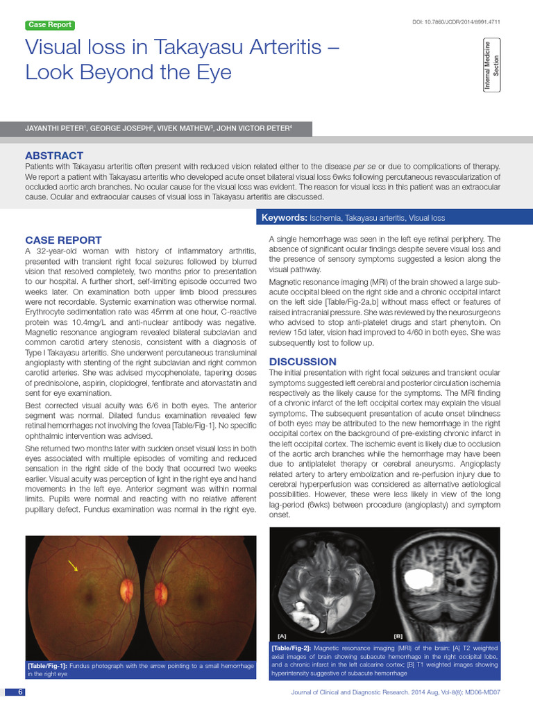jcdr-8-MD06 240610 185657 | PDF | Glaucoma | Ischemia