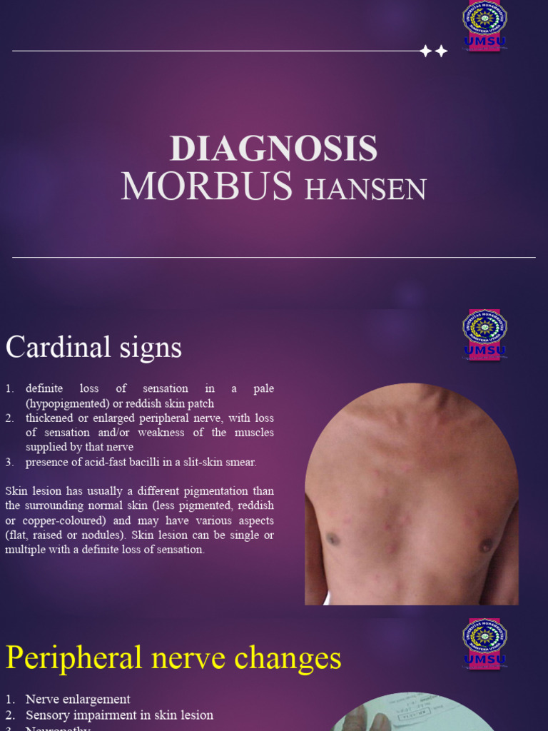 CMD Morbus Hansen (Kusta) | PDF | Leprosy | Peripheral Neuropathy