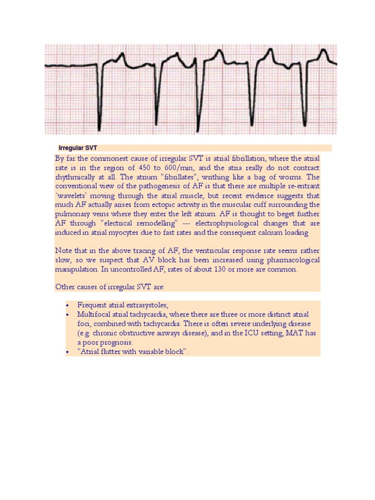 Irregular SVT | PDF