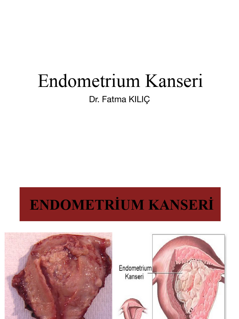 8-Endometrium Ca | PDF