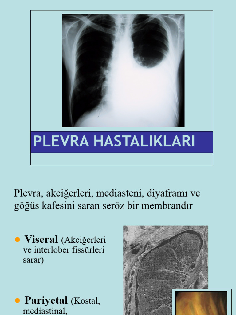 4-Plevra Hastalıkları | PDF