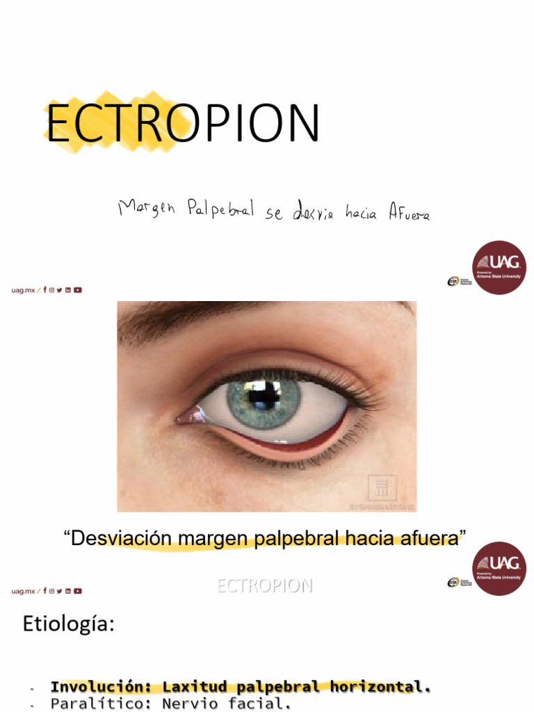 Ectropion y Entropion | PDF | Enfermedades y trastornos | Oftalmología