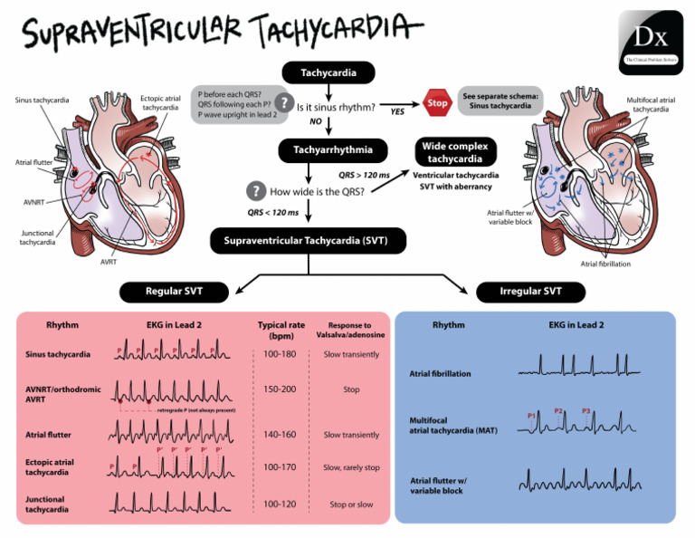 Supraventricular Tachycardia | PDF