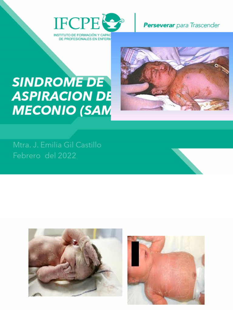 Sindrome de Aspiración de Meconio | PDF | Parto | Infantes