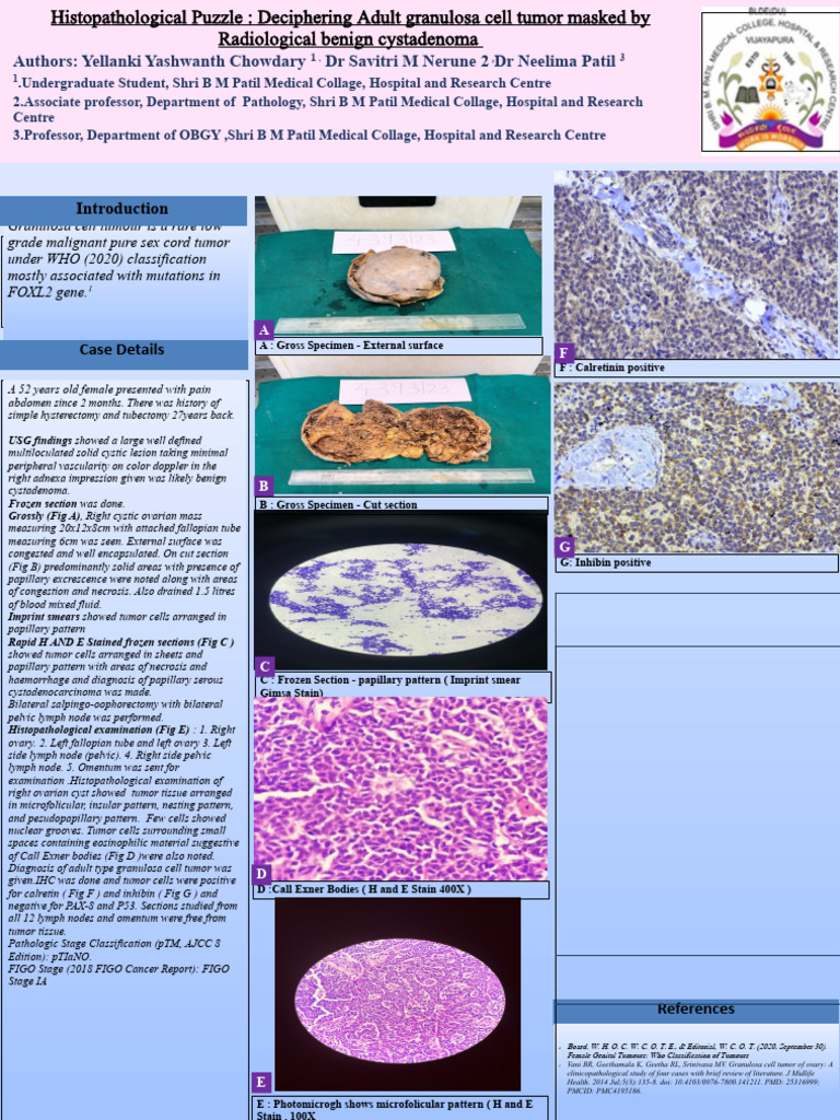 Poster | Download Free PDF | Neoplasms | Ovarian Cancer