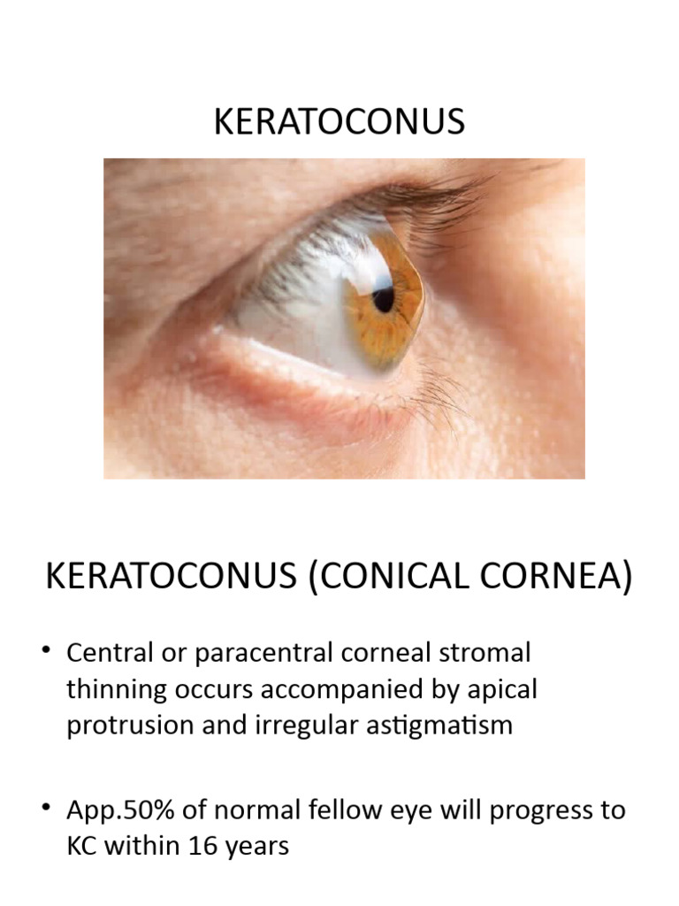 KERATOCONUS | PDF | Cornea | Ophthalmology