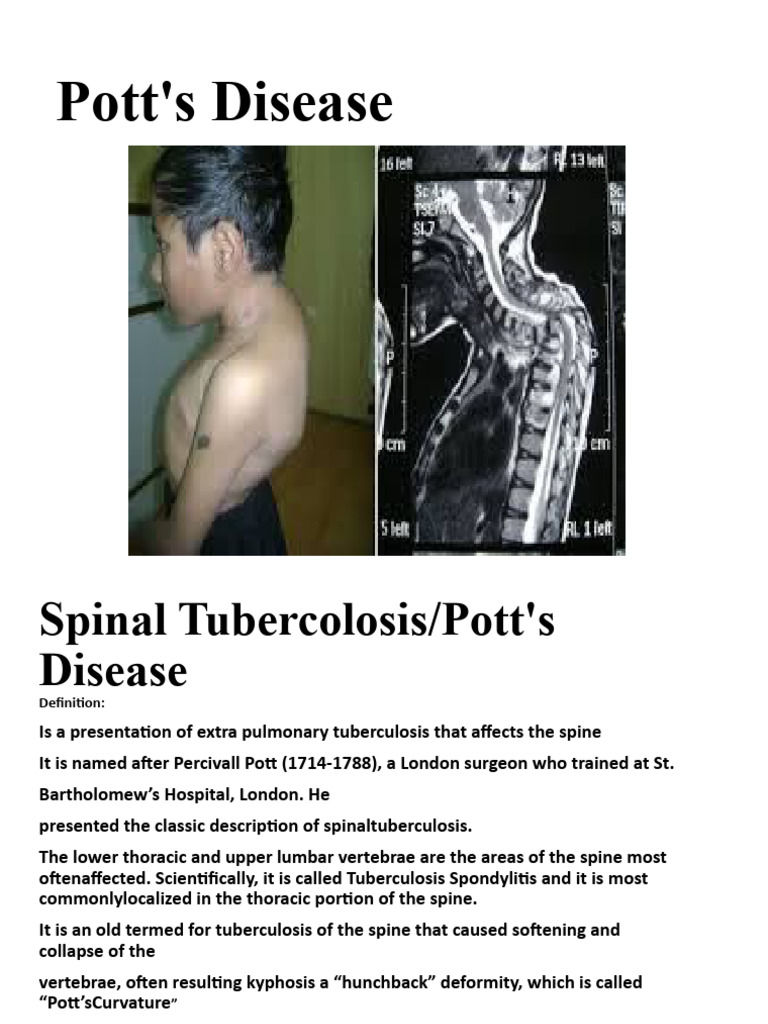 Pott S Disease Wps Office Pdf Vertebral Column Tuberculosis