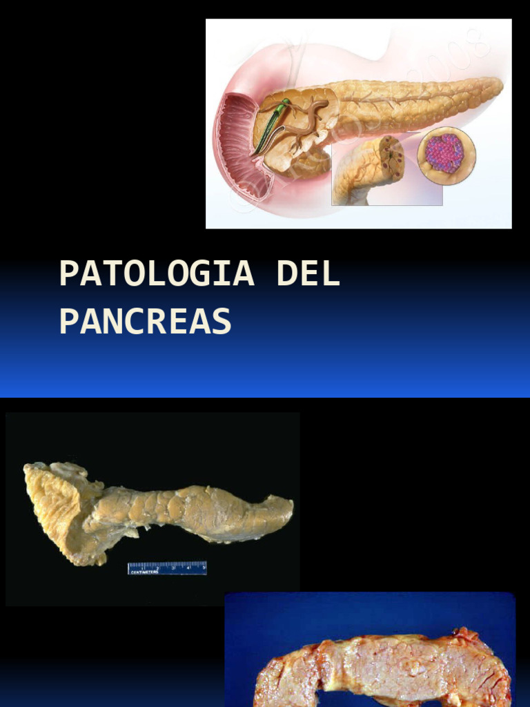 Patologia Pancreática y Hepática | PDF | Páncreas | Metástasis