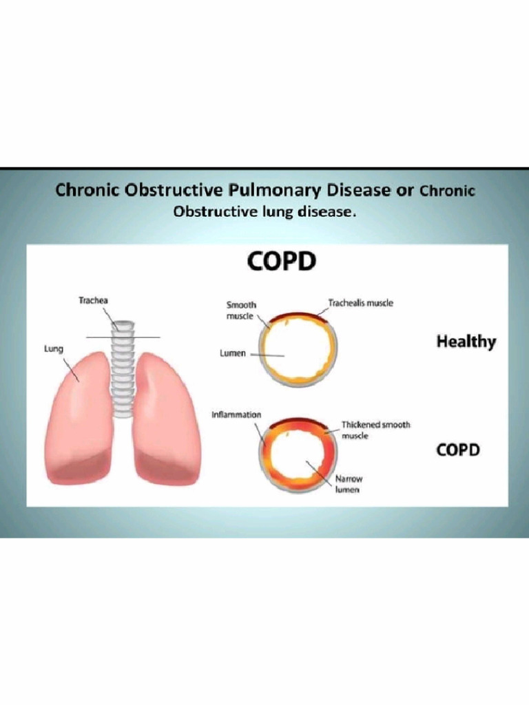 Copd | PDF