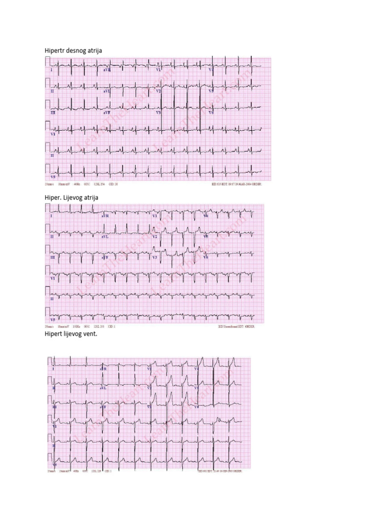 Ekg | PDF