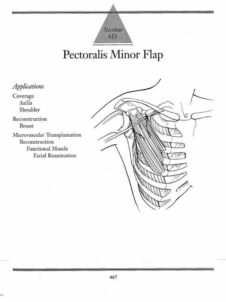 Mathes CH6 Pectoralis Minor Flap | PDF
