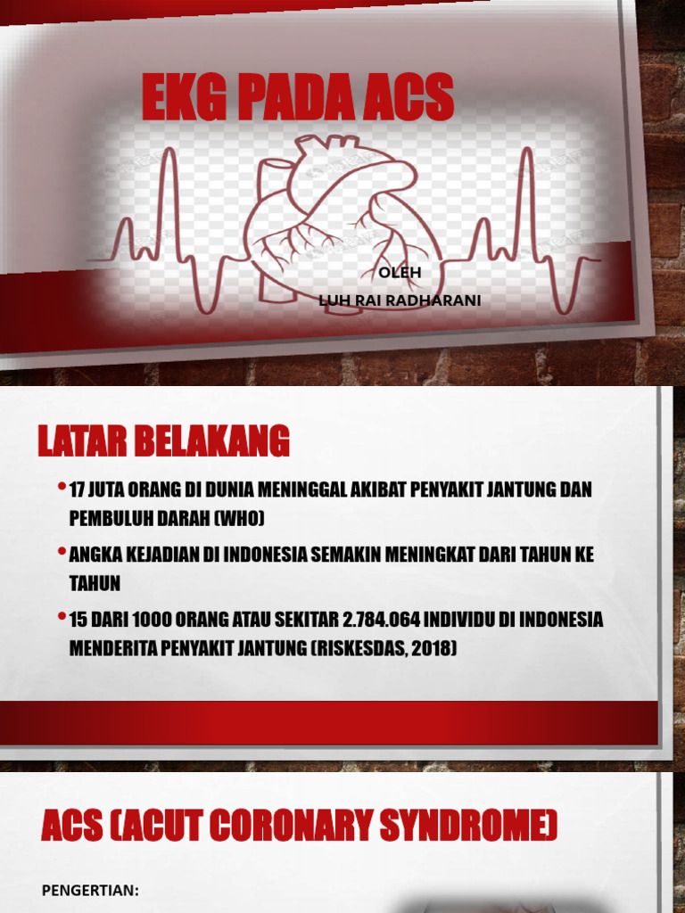 Ekg Pada Acs | PDF