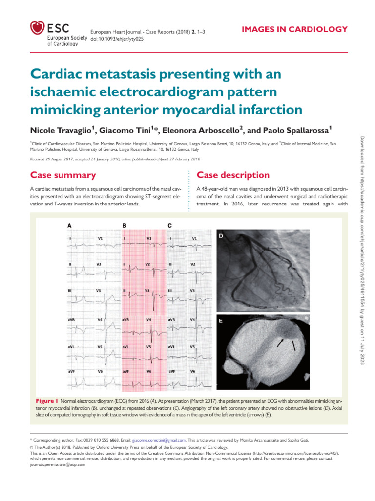 Mimicking Stemi in Cardiac Metastasis Esc | PDF | Heart ...