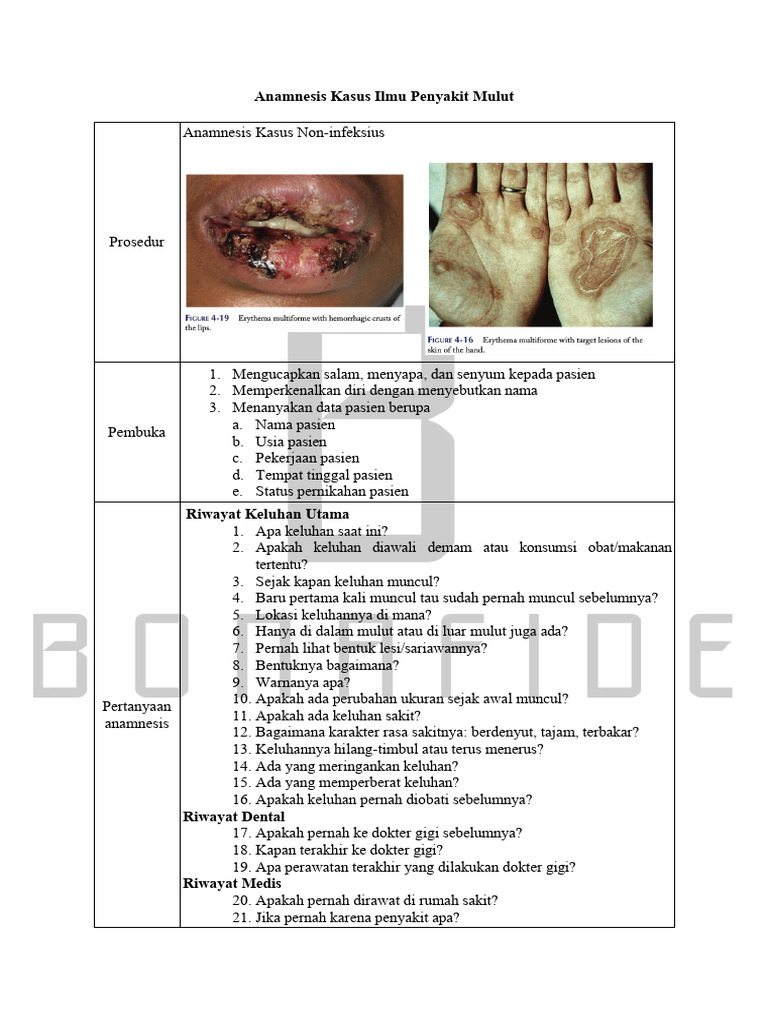 ERYTHEMA MULTIFORME [EM] | PDF