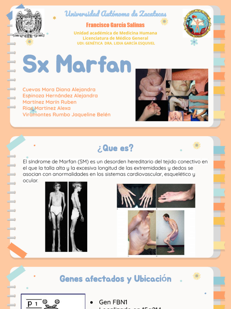 SX de Marfan | PDF