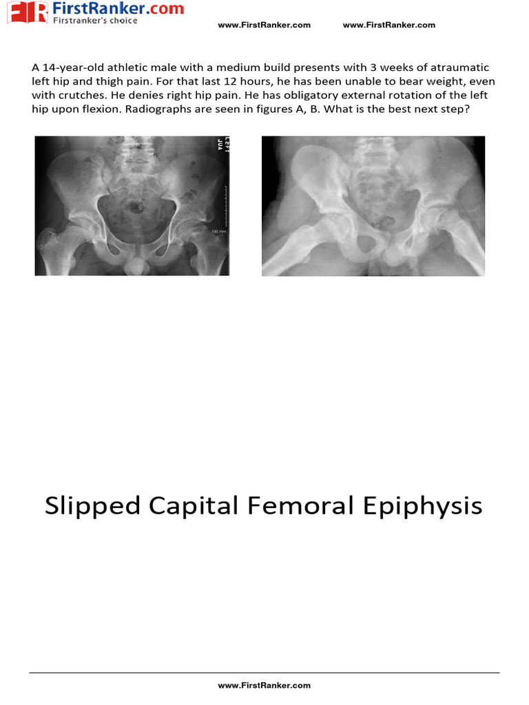 ORTHO Slipped Capital Femoral Epiphysis | PDF | Musculoskeletal ...