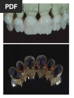 Perio-Prosthodontic Pontic Site Management, Part I: Pontic Designs and ...