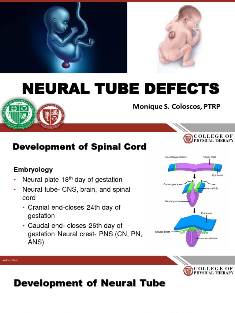 PRAT - Neural Tube Defects | PDF | Clinical Medicine | Human Diseases ...