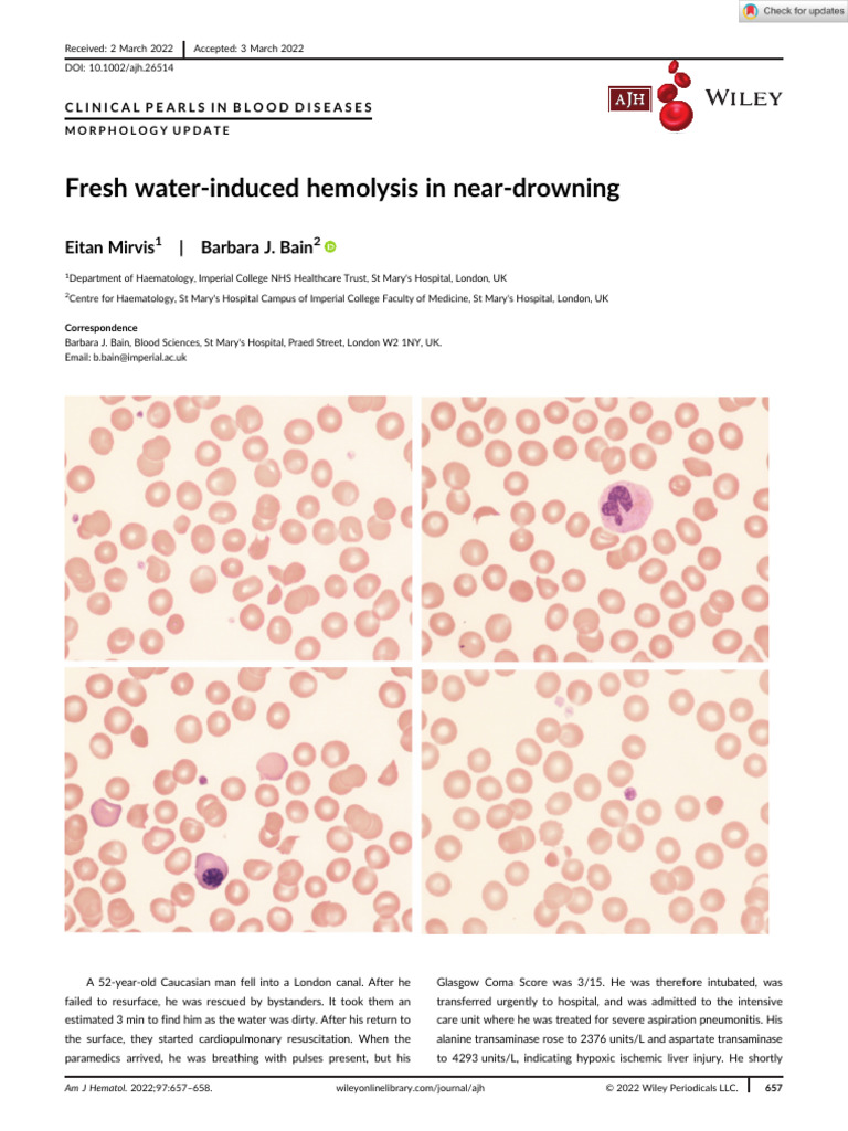 American J Hematol - 2022 - Mirvis - Fresh water‐induced hemolysis in ...