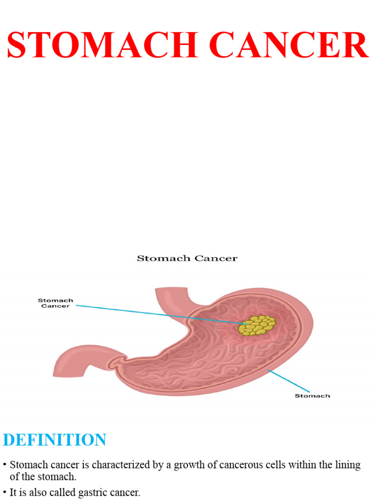 Stomach Cancer | PDF | Cancer | Metastasis