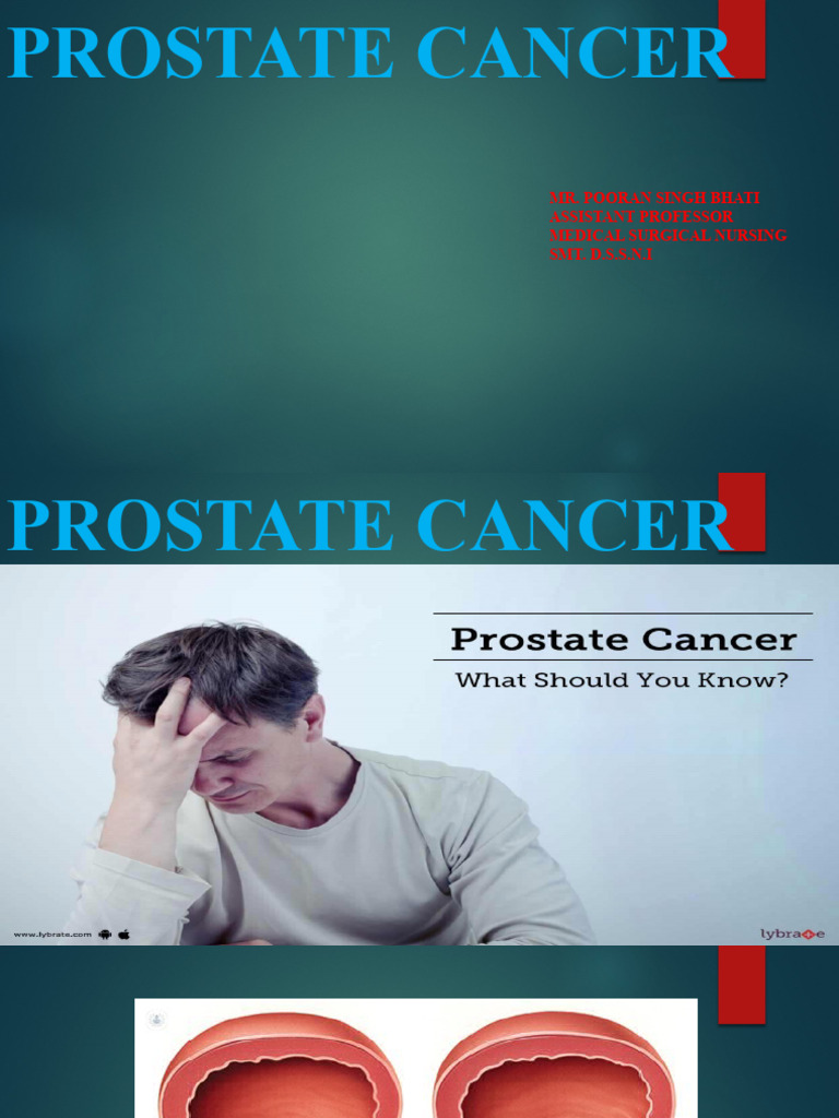 Prostate Cancer | Download Free PDF | Prostate | Prostate Cancer