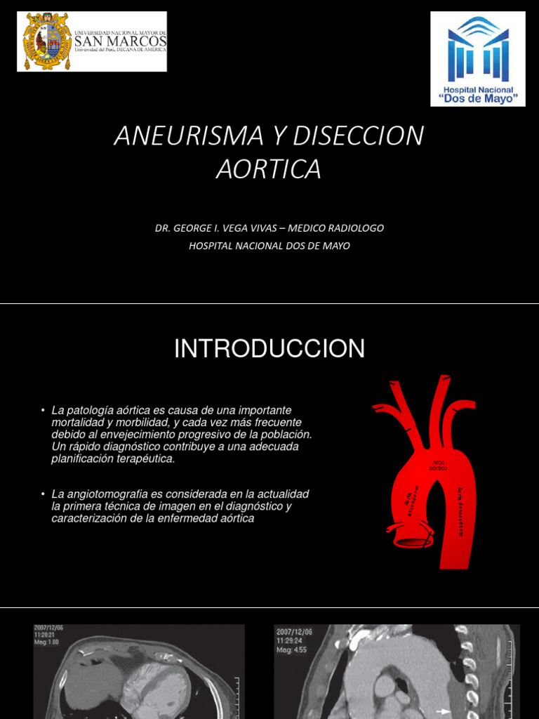 Aneurisma y Diseccion Aortica | PDF | Aorta | Angiología