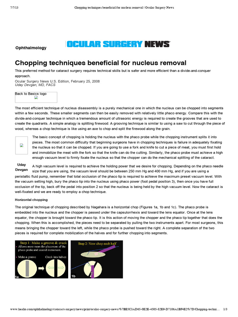 Chopping techniques beneficial for nucleus removal | PDF ...