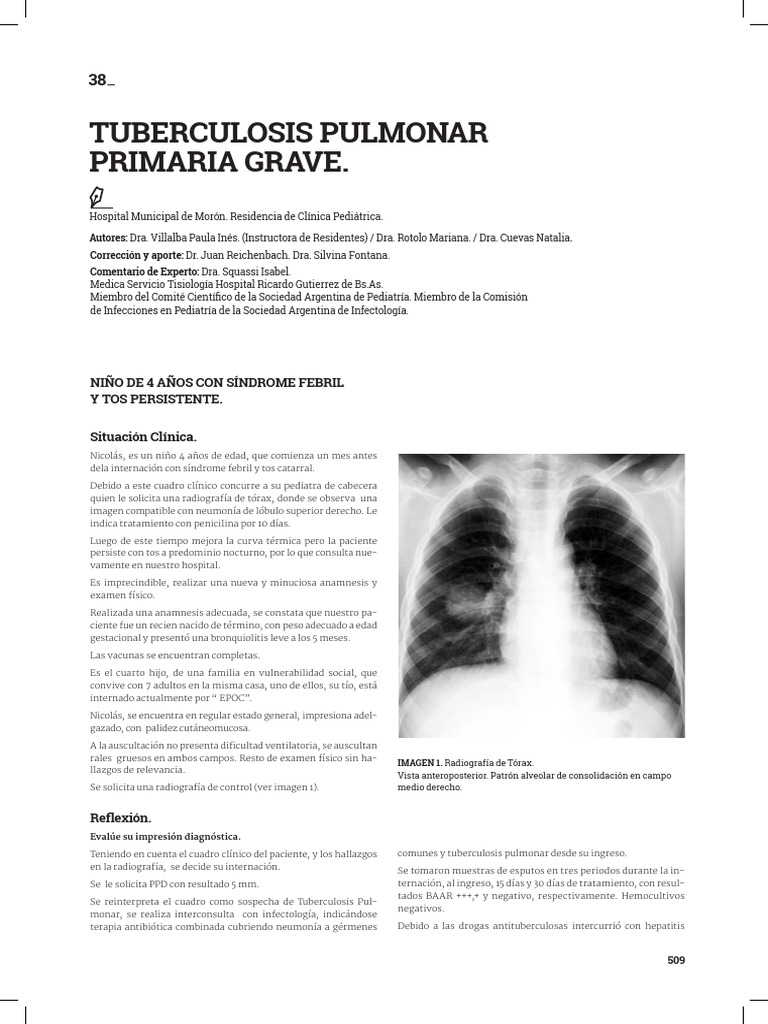 Tuberculosis Pulmonar | PDF | Tuberculosis | Neumonía