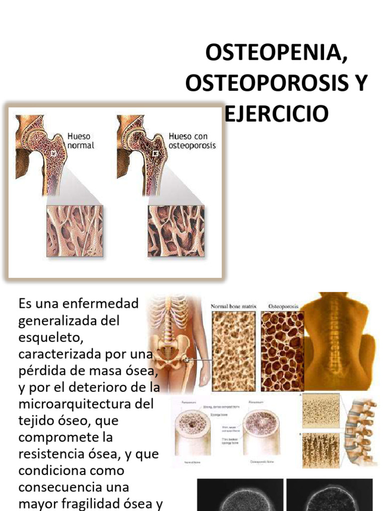 Osteopenia, Osteoporosis y Ejercicio | PDF | Osteoporosis | Hueso