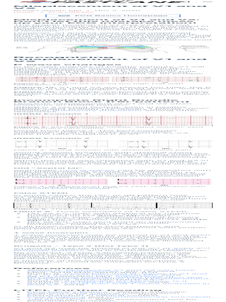 Misplacement of V1 and V2 - LITFL - ECG Library Basics | PDF ...