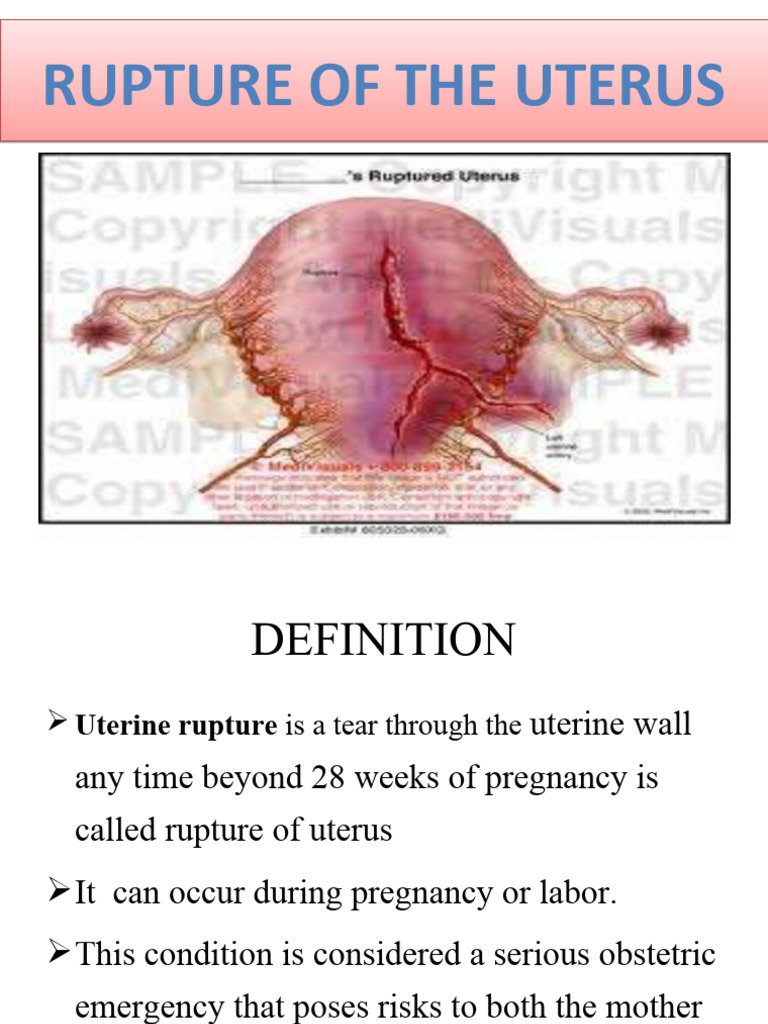 Rupture of The Uterus | PDF | Childbirth | Uterus