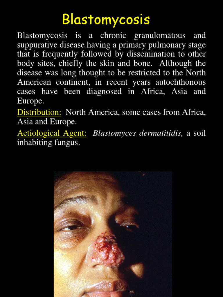 Global Distribution of Blastomycosis | PDF
