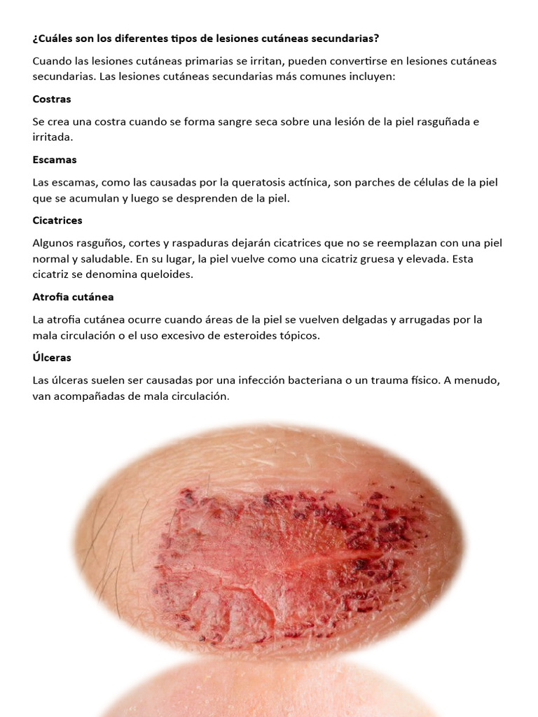 Cuáles Son Los Diferentes Tipos de Lesiones Cutáneas Secundarias | PDF ...