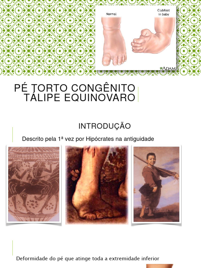 Pé Torto Congênito | PDF | Pé | Sistema Locomotor